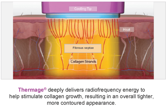 Why Radiofrequency Treatments Are Becoming More Popular - SBA Dermatology Why Radiofrequency Treatments Are Becoming More Popular - SBA Dermatology